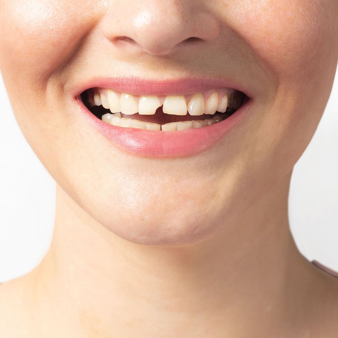 Gigi Patah Setengah, Simak Cara Mengatasinya - Asha Dental Care
