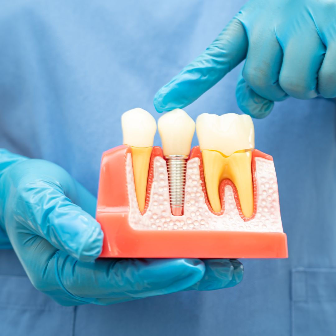 Simak Bahaya Sisa Akar Gigi Dan Ini Solusinya - Asha Dental Care